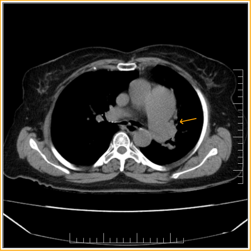 Long standing left to right shunt-CT - Sumer's Radiology Blog