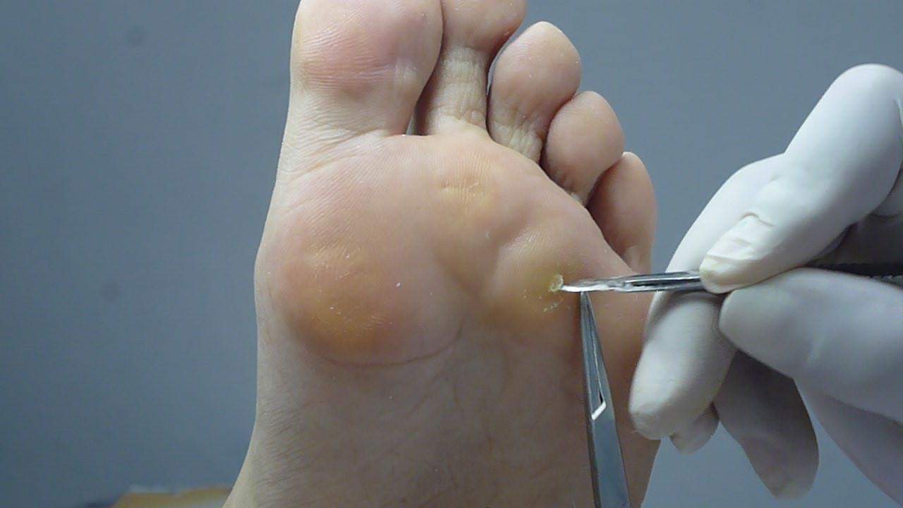 Podología Bethy: Heloma Plantar