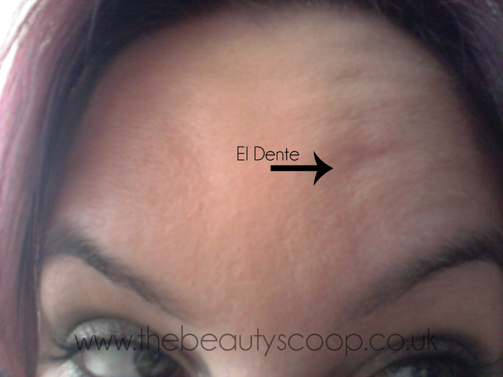 The Beauty Scoop!: The Botox Diaries - Frown Line Day 16.... & Forehead ...