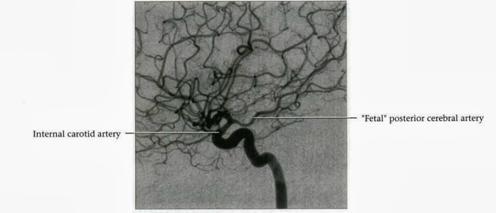 Ultimate Radiology : Fetal PCA
