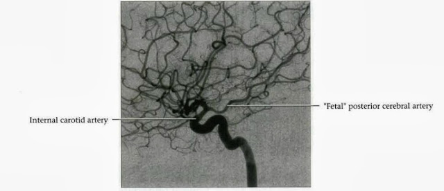 Ultimate Radiology : Fetal PCA
