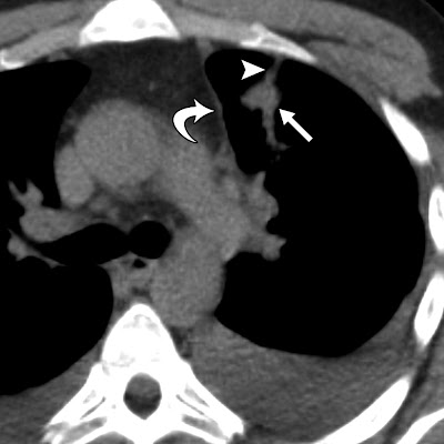 Infection Landscapes: Lung Flukes: Paragonimiasis