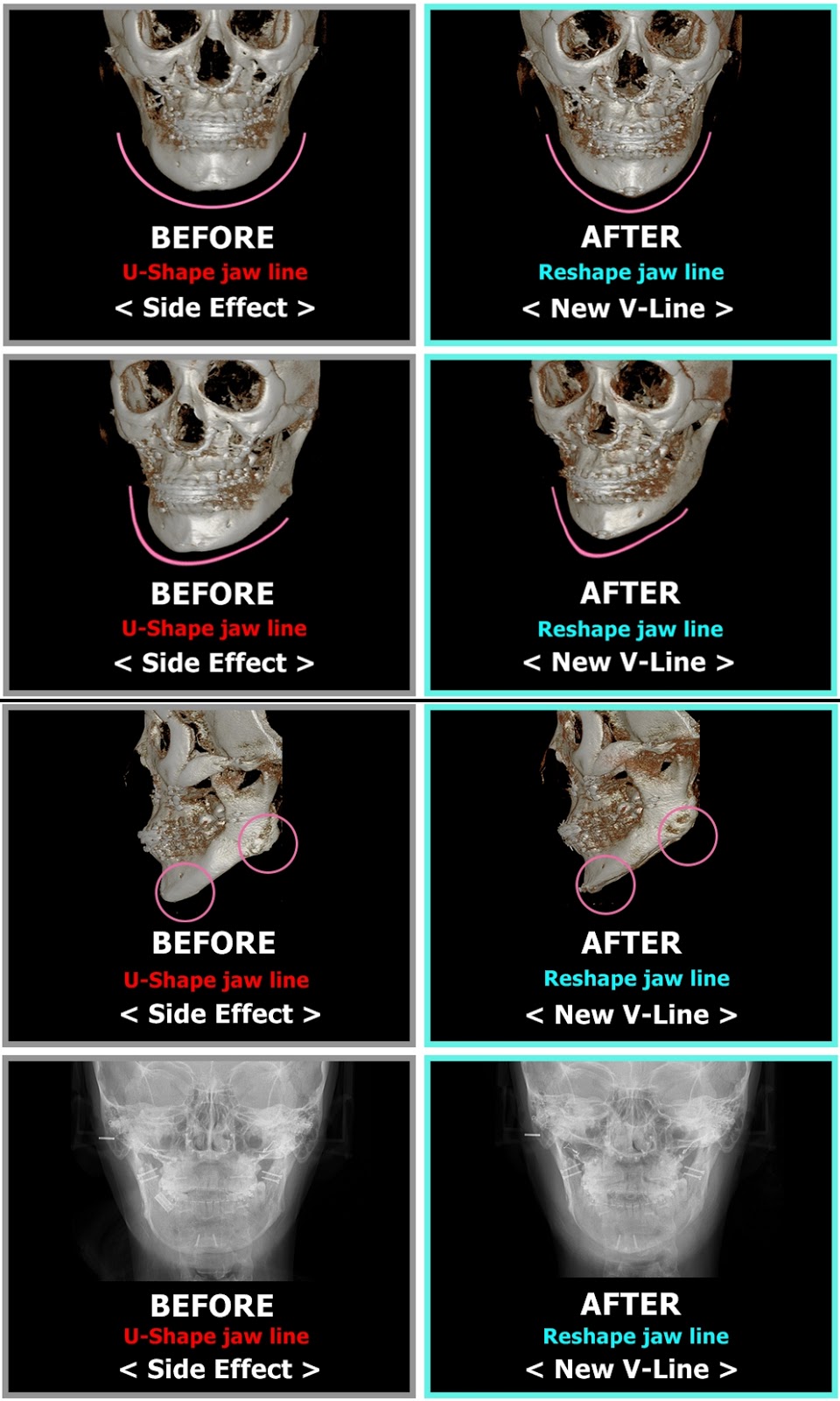 Girin Information Center - Facial Contouring Revision (Jaw reduction ...