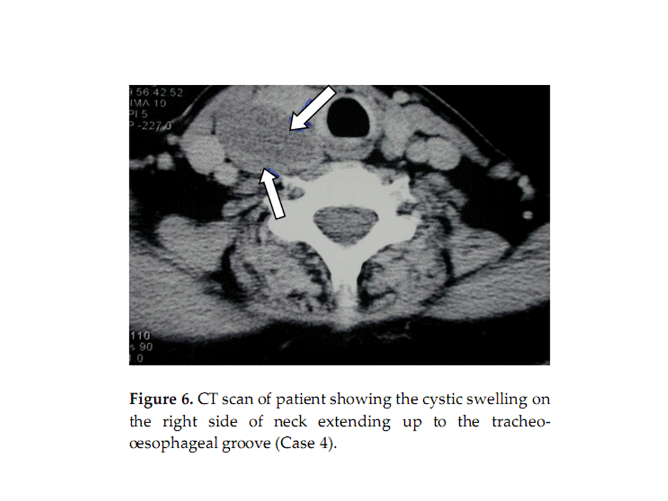 BÀI SOẠN VỀ SIÊU ÂM CHẨN ĐOÁN: CYSTIC PARATHYROID ADENOMA