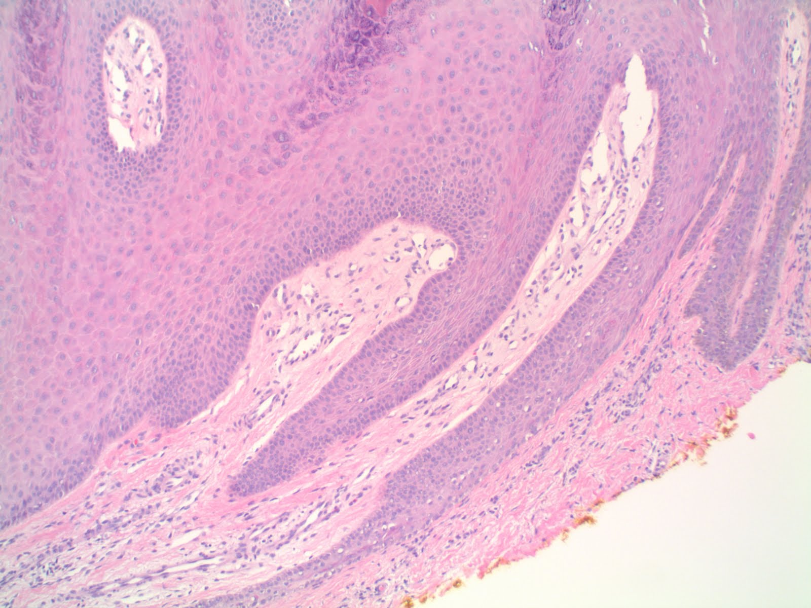 Dermatopathology: Verruca vulgaris