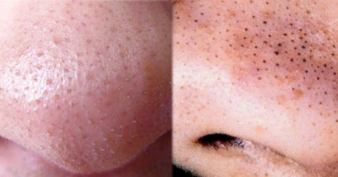 Jenis-jenis Komedo dan Cara Mencegahnya, No.2 Lebih Sulit Dihilangkan ...