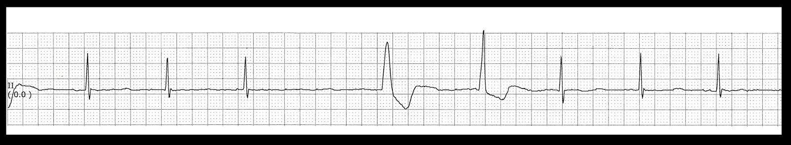 EKG Rhythm Quiz 274