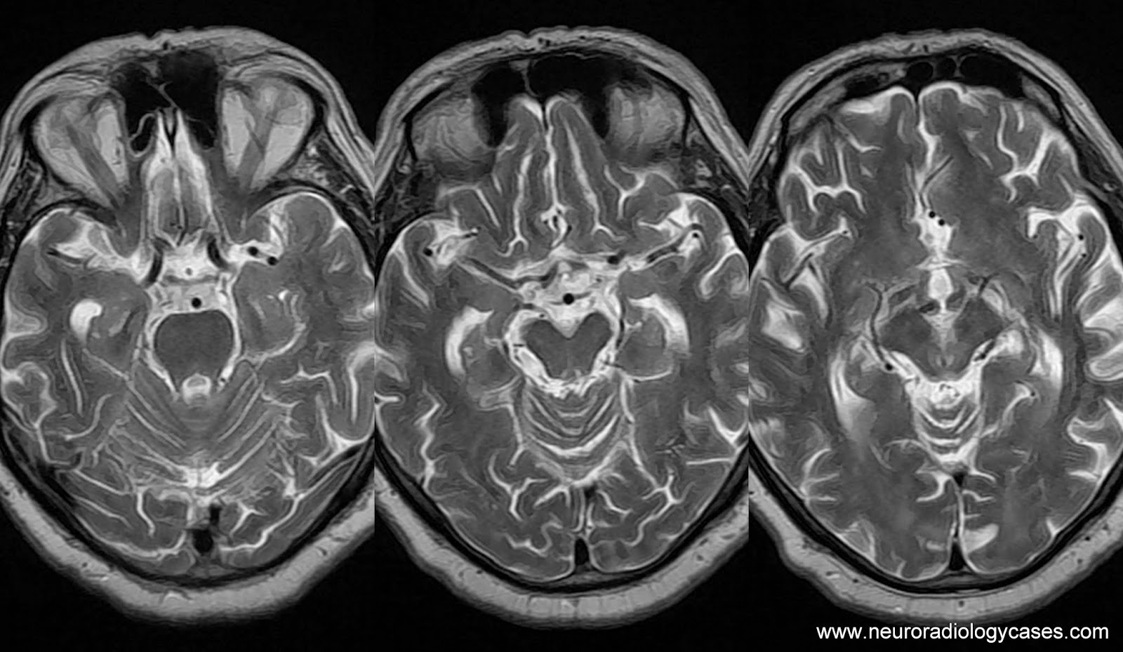Dr Balaji Anvekar FRCR: Progressive Supranuclear Palsy MRI