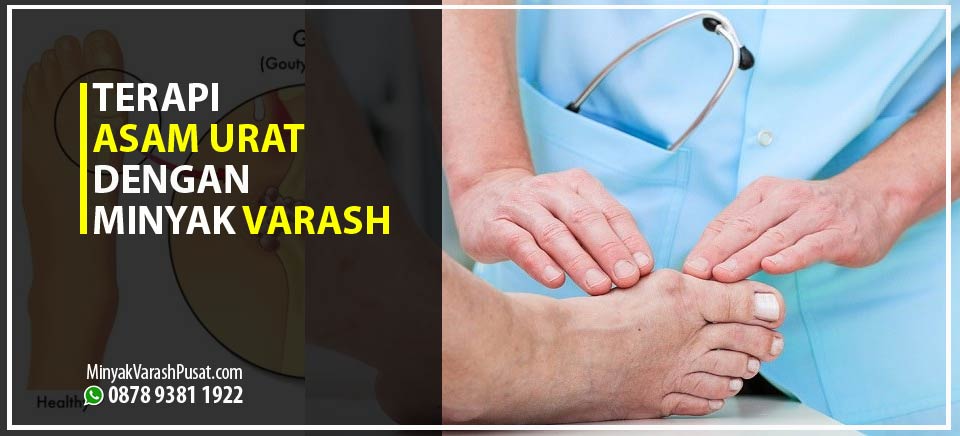 ALAMI, Obat Asam Urat atau Gout dan Cara Terapi pakai Minyak Varash