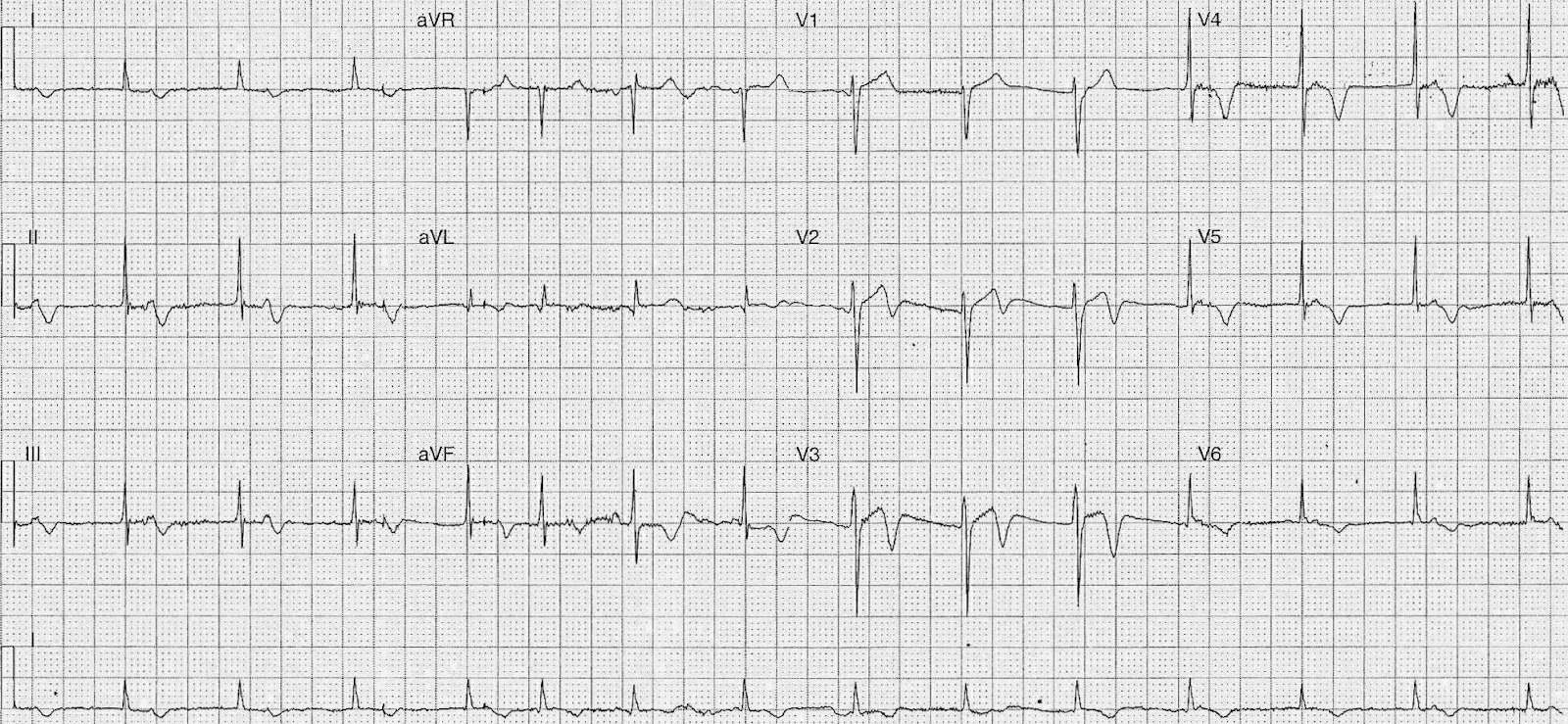 ECG of the Week: ECG of the Week - 8th October 2012 - Interpretation