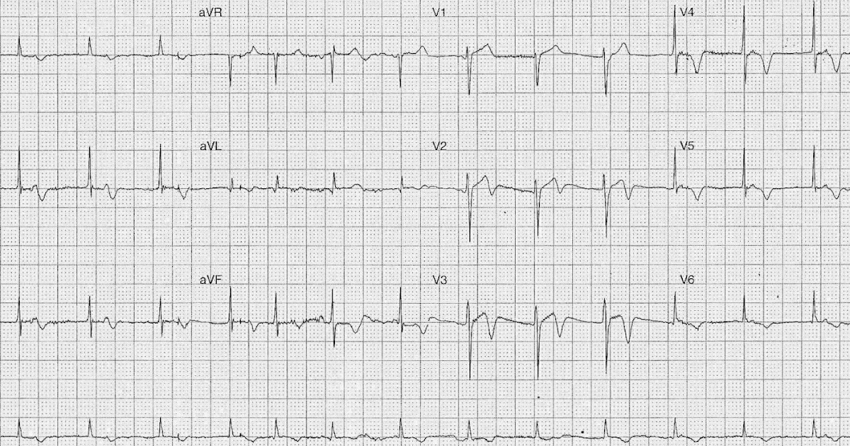 ECG of the Week: ECG of the Week - 8th October 2012 - Interpretation