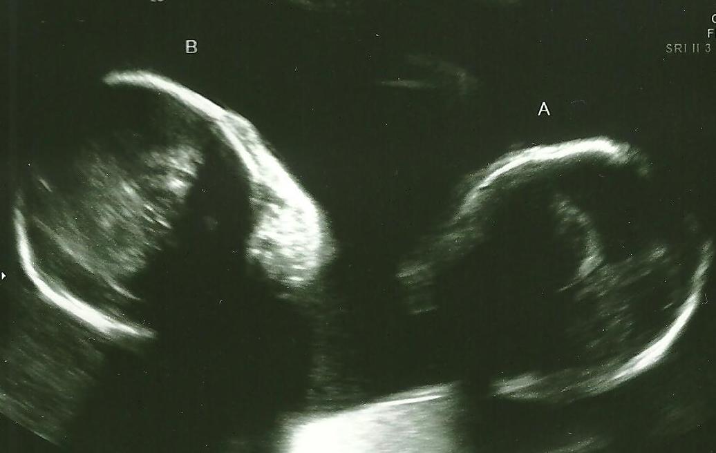 2 New Rubys: 31 Weeks: Growth Scan + MFM appt