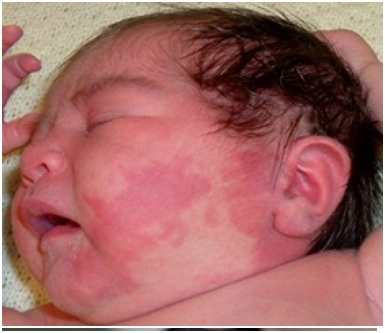 Blog de Neonatología