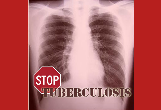 Sehat dan Sukses Bersama Melia Nature Indonesia: Stop TBC Dengan DOTS ...