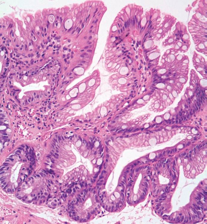 PATOLOGIA: PATOLOGIA GASTROINTESTINAL 1. ESOFAGO.