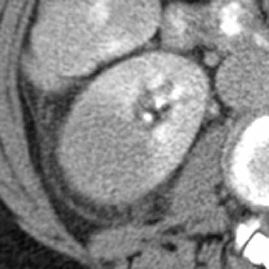 Ultimate Radiology : CASE OF BILATERAL PYELONEPHRITIS