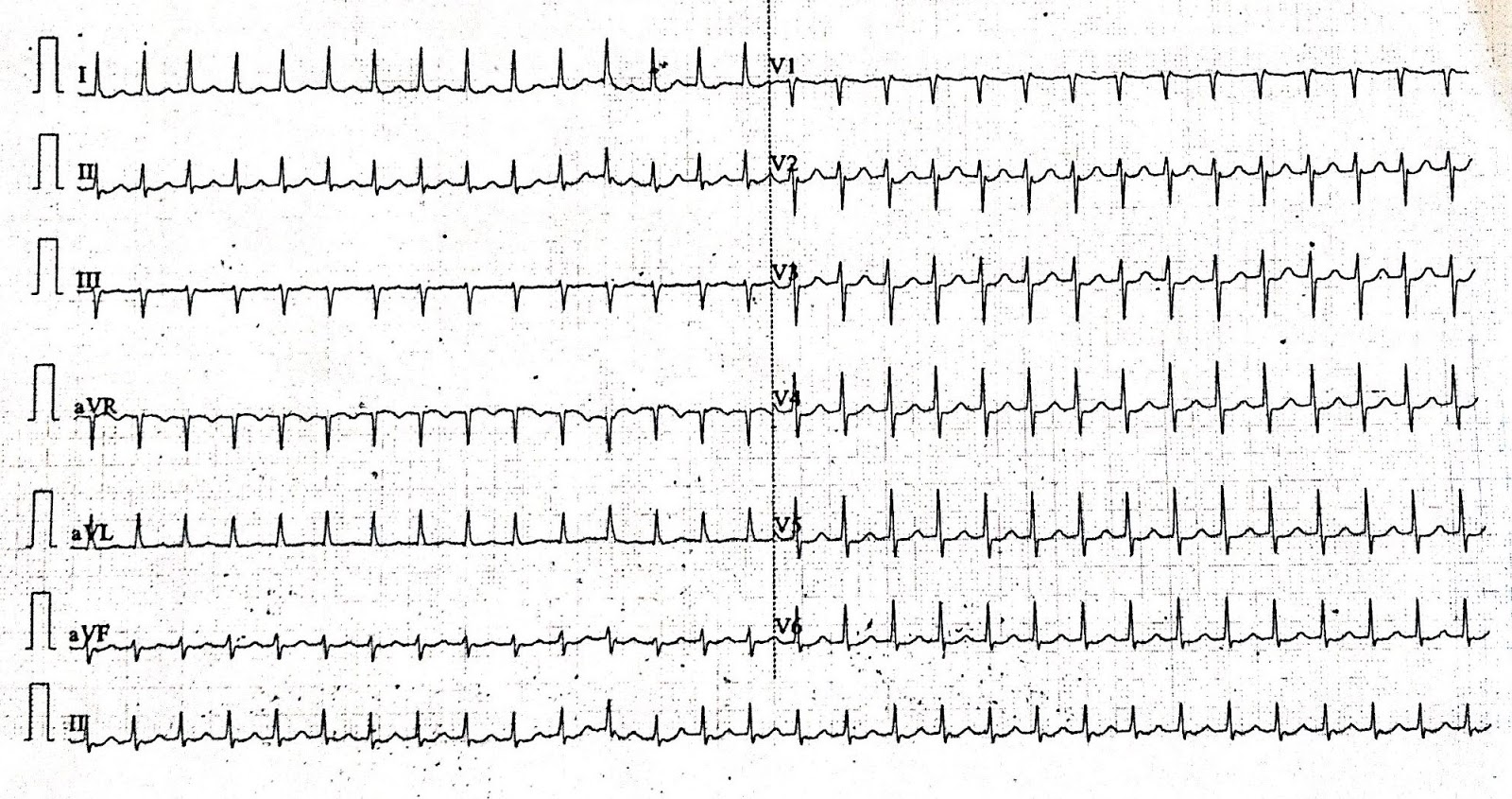 Cardiology window: PSVT