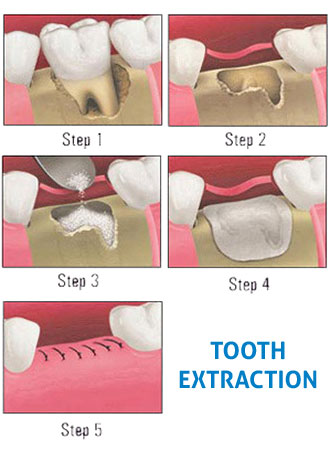 dentistry for children : Simple and Surgical Extractions