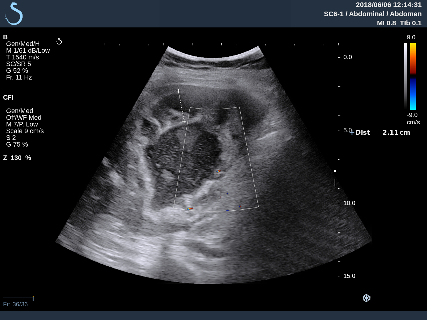 VIETNAMESE MEDIC ULTRASOUND: CASE 498: GALLBLADDER ABSCESS, Dr PHAN ...