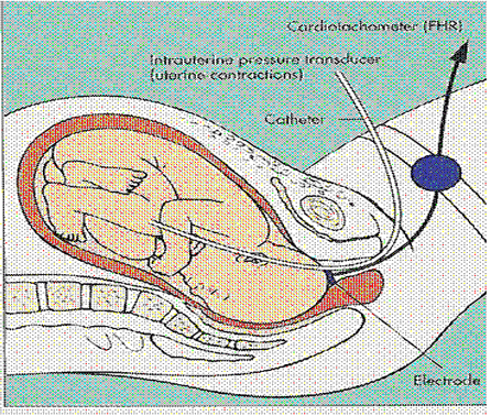 Mbbs, BDS, B-Pharma Notes: Methods of Assessing Fetal Status