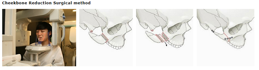 Lahir Kembali dengan Cheekbone Reduction