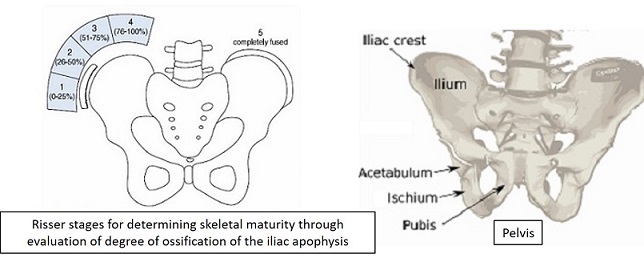Scoliosis ( Skoliosis ): Risser Sign ( Kematangan Tulang )