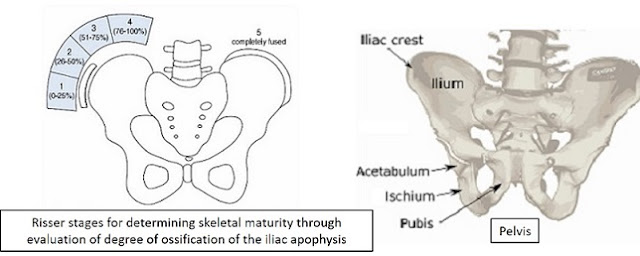 Scoliosis ( Skoliosis ): Risser Sign ( Kematangan Tulang )
