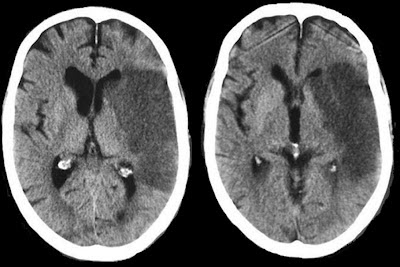Dr Balaji Anvekar FRCR: Ischemic stroke and Vascular territories of Brain