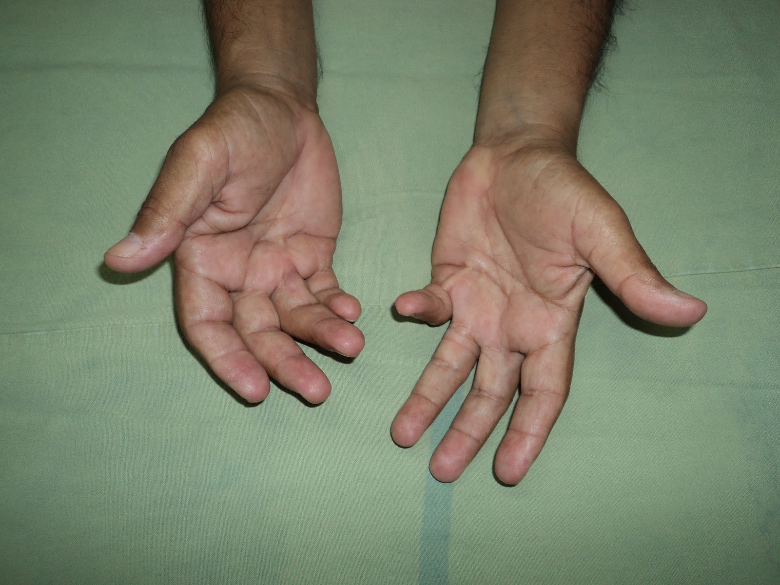 OSSA CARPALIA ©: Hipertrofia de la fascia palmar: ¿Dupuytren?