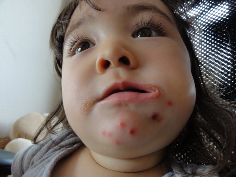 mayamoche's life in Tokyo/Cologne: Impetigo contagiosa / Grindflechte