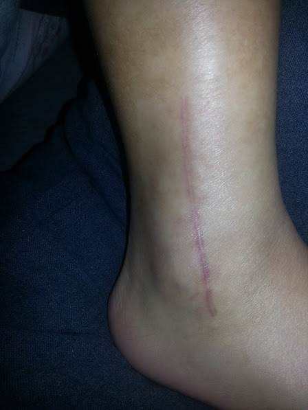 My Broken Ankle =(: Day 98 - 4 New Balancing Exercises