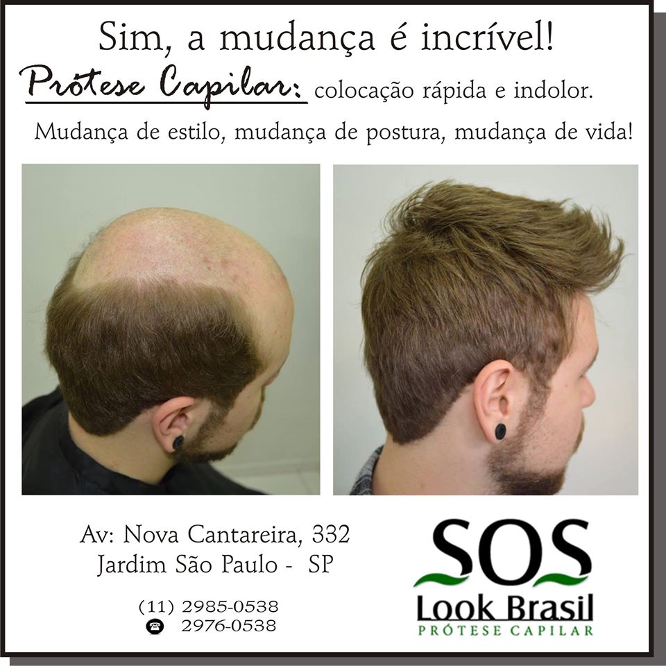 DÚVIDAS PRÓTESE CAPILAR : Prótese capilar masculina antes e depois