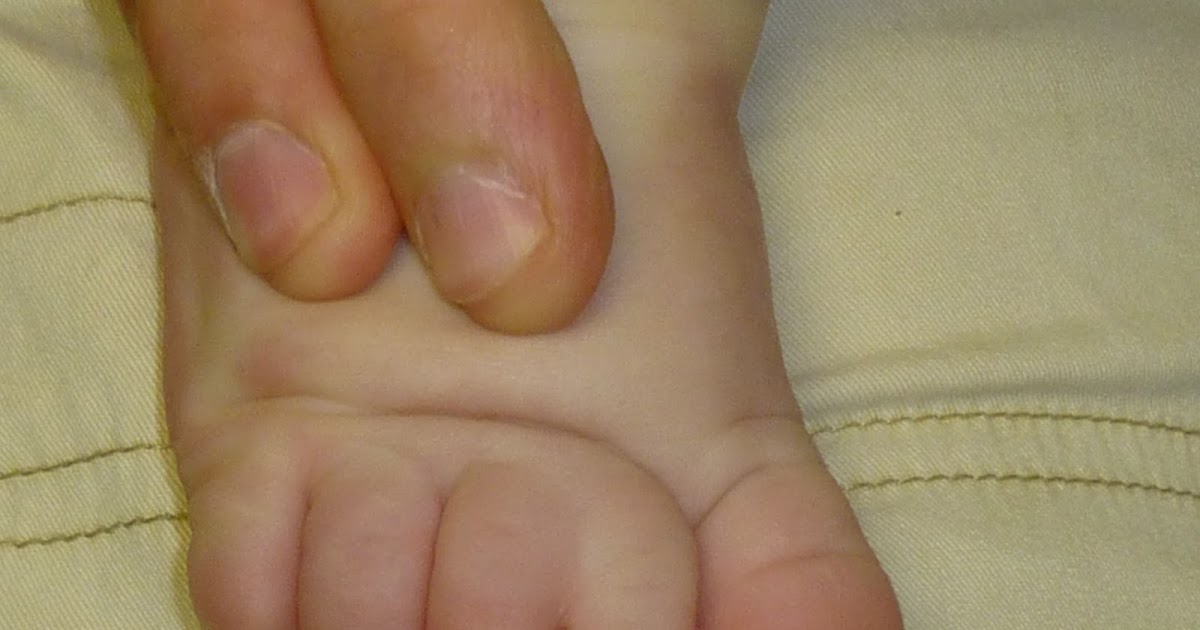 Long Fingers And Toes Syndrome at Eileen Towner blog
