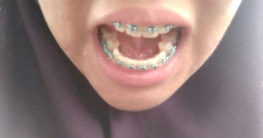 "Peel it. Feel it.": Review Pendakap Gigi: What To Expect?