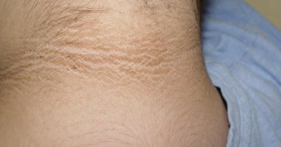 Doenças BR: Acantose Nigricans - Fotos, Sintomas e Tratamento