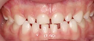 Estomatología Comunitaria: Dentición Temporal y Dentición Definitiva