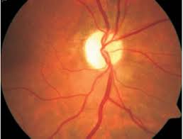 ¿Qué es la Atrofia Óptica? - Por Una Visión Saludable