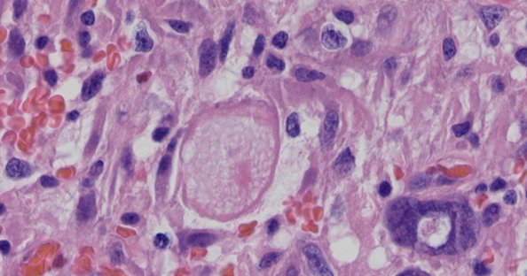 neuropathology blog: Xanthic cell in a pleomorphic xanthastrocytoma