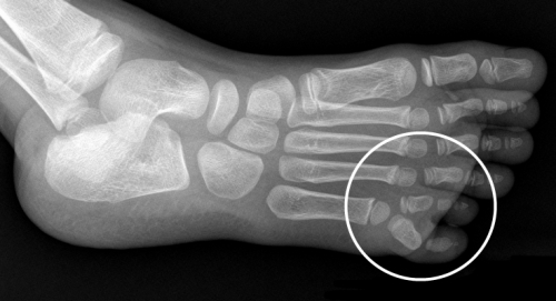 Three Pipe Problem: Recounting Raphael's digits