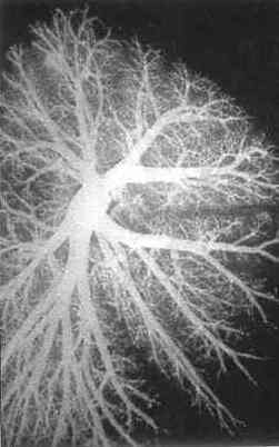 Pedi cardiology: Pulmonary Artery Hypertension - Arborization by ...
