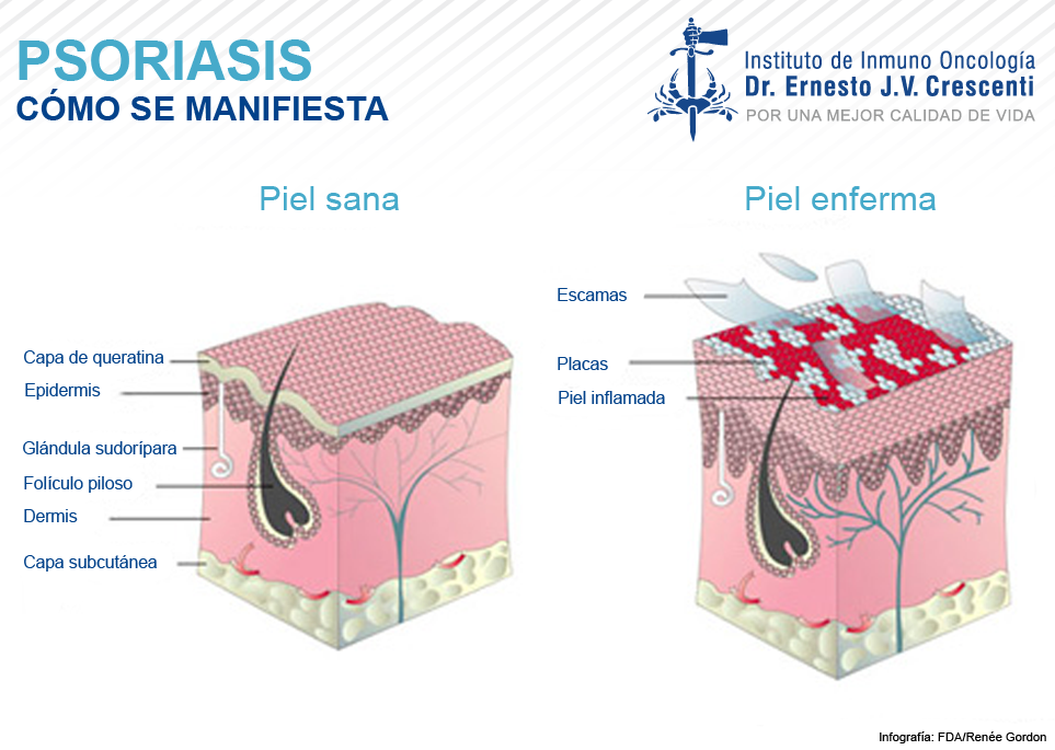 Psoriasis | Psoriasis, Enfermedades del cuero cabelludo, Enfermedades ...