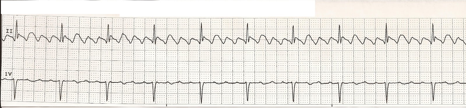 EKG Rhythm Strips 41