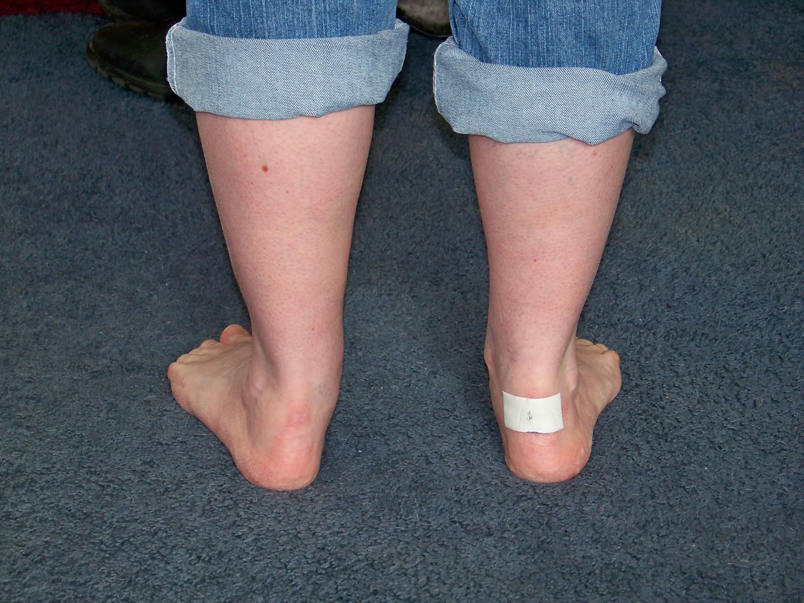 My posterior tibial tendon surgery journey: 3 month check up (before ...