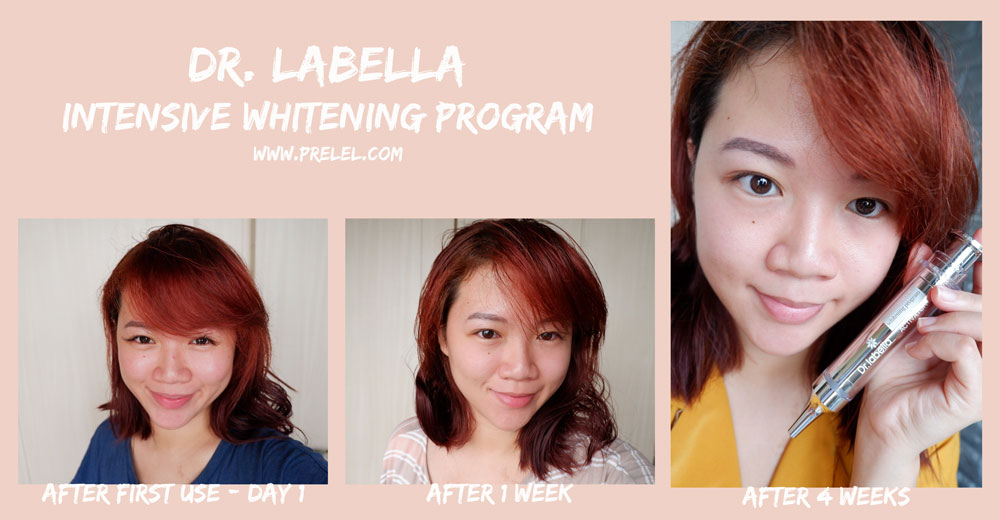 Dr. Labella Intensive Whitening 4 Week Miracle Program Review, Before & After