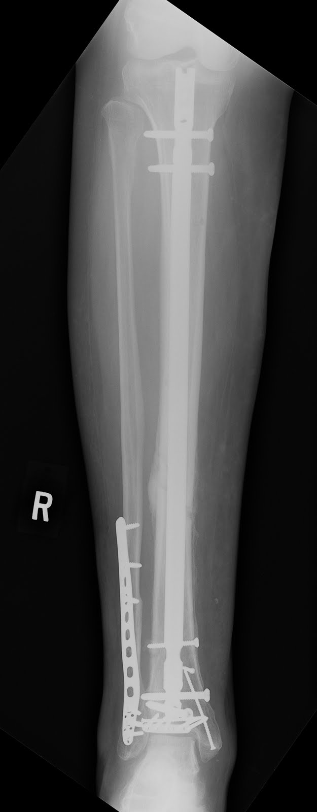 Case of the Month: Fracture cases at Harborview Medical Center ...