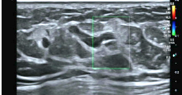 VIETNAMESE MEDIC ULTRASOUND: CASE 547: MONDOR'S DISEASE, Dr PHAN THANH ...