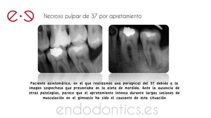 Endodoncia Microscópica en Zaragoza: Necrosis pulpar en 37 por ...
