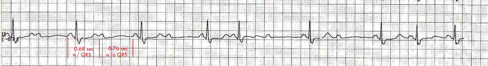 ECG Rhythms: WAP/MAR/MAT/Sinus arrhythmia