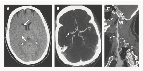 Manuali di Medicina Intensiva: Ictus ischemico cerebrale - aspetti ...