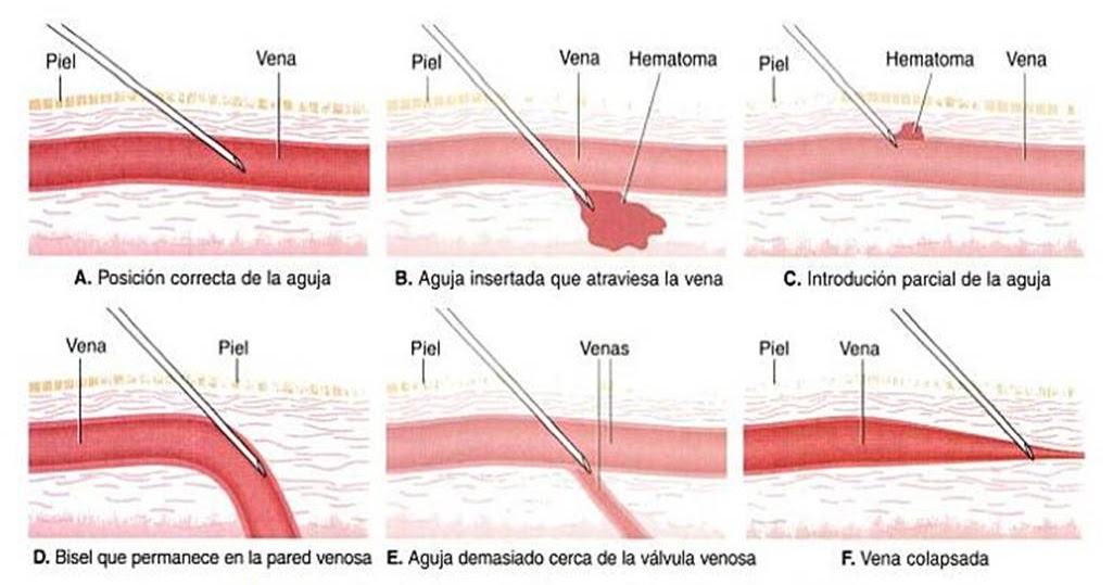 venopuncion